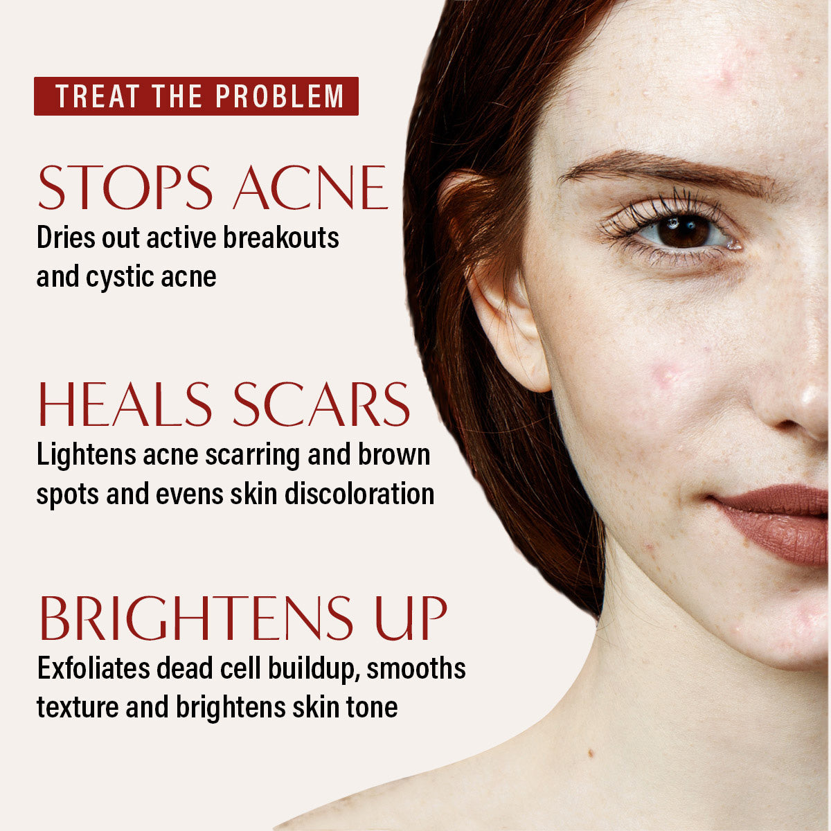 Stop Zit! Anti-Acne Retinol Complex 1 oz – Best Face & Body